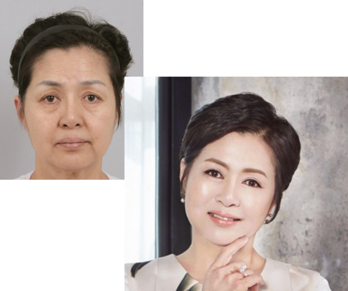 Deep Plane Facelift vs. SMAS Facelift: What’s the Difference?